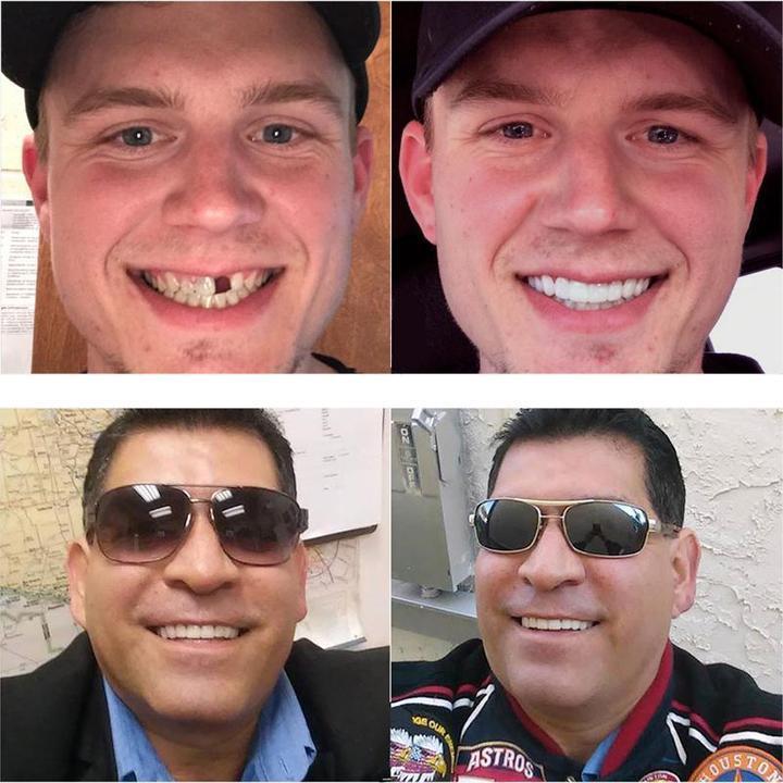 snap on instant smile veneers – The White Bright