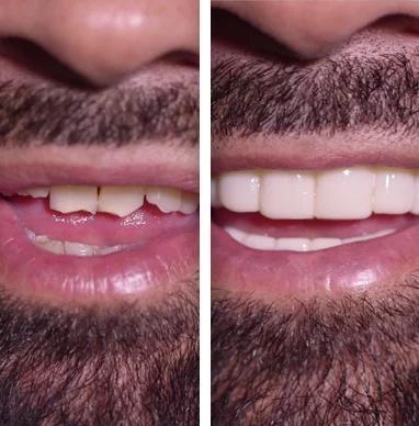 The Original Snap On Smile Amazing Perfect & Confident Smile Clip On V ...